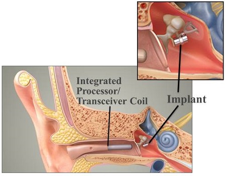 Implantable Auditory Technologies Ravi Sockalingam Bone Conduction & Middle Ear Implants/Aids ...